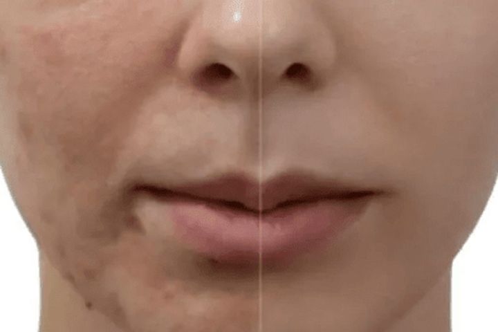 Acne & Scars PRP Treatment in London | Ireland | India