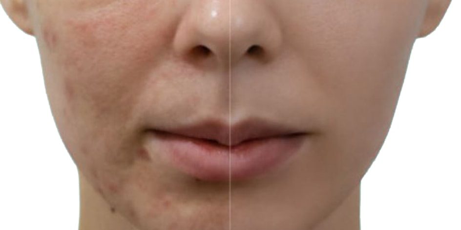 Acne & Scars PRP Treatment in London | Ireland | India