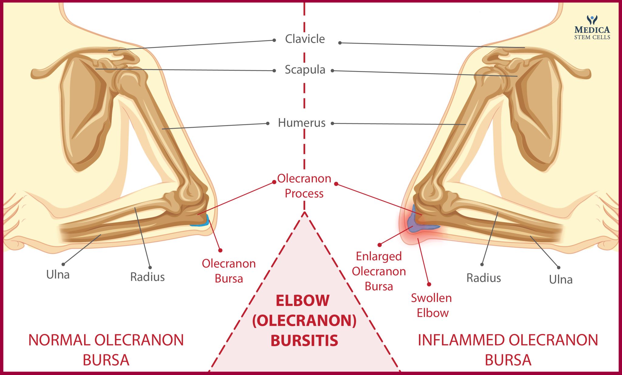 Elbow Bursitis Regenerative Stem Cells Therapy London | Ireland | India
